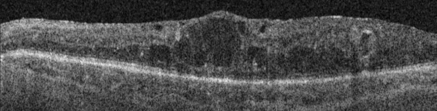 Diabetic Retinopathy - Anikina Retinal and Cataract