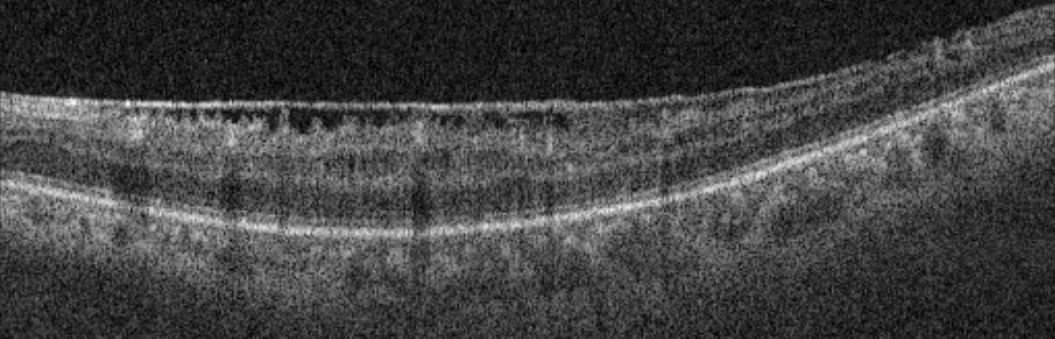 Epiretinal Membrane - Anikina Retinal and Cataract